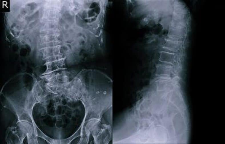 Spondilite Anchilosante Sintomi E Trattamento Nella Zona Lombare - 5 ...