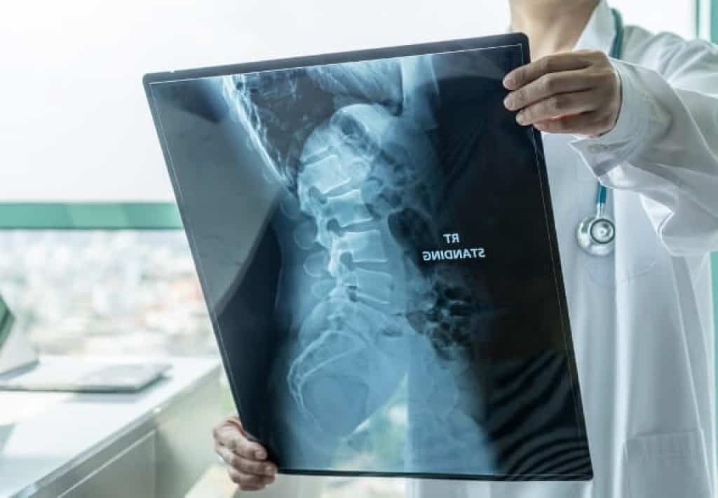 Spondilite Anchilosante Sintomi E Trattamento Nella Zona Lombare - 5 ...